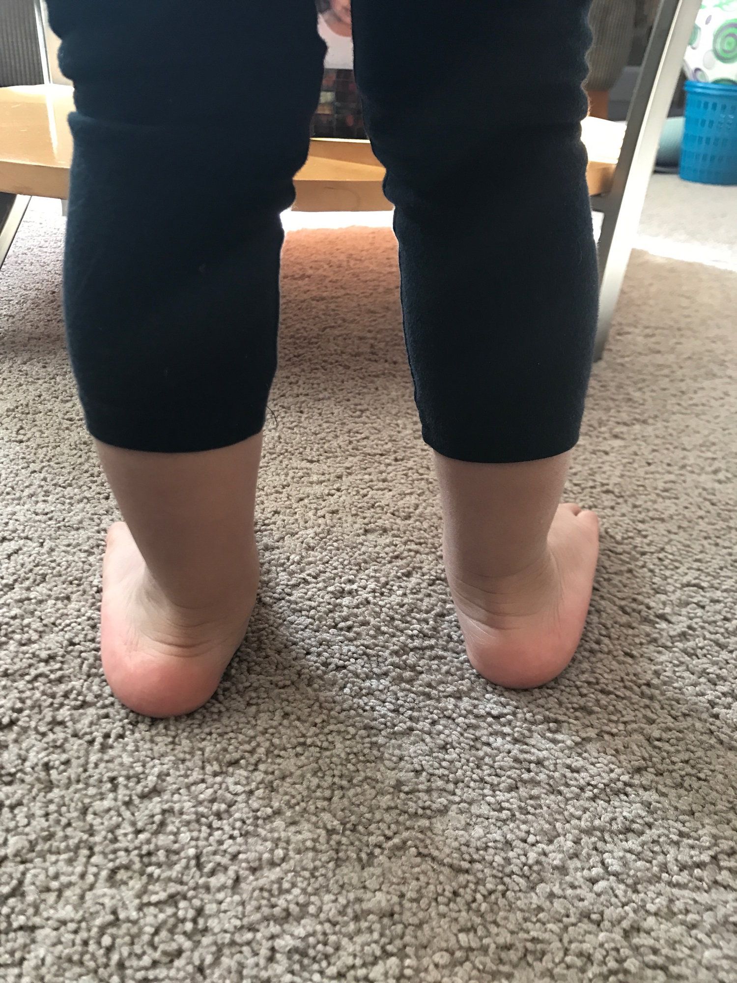 Down Syndrome and Hypotonia